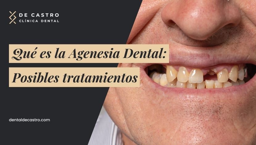 Agenesia dental 🦷 Qué es y cómo Solucionarla de una vez