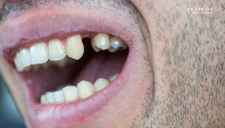 Agenesia dental 🦷 Qué es y cómo Solucionarla de una vez